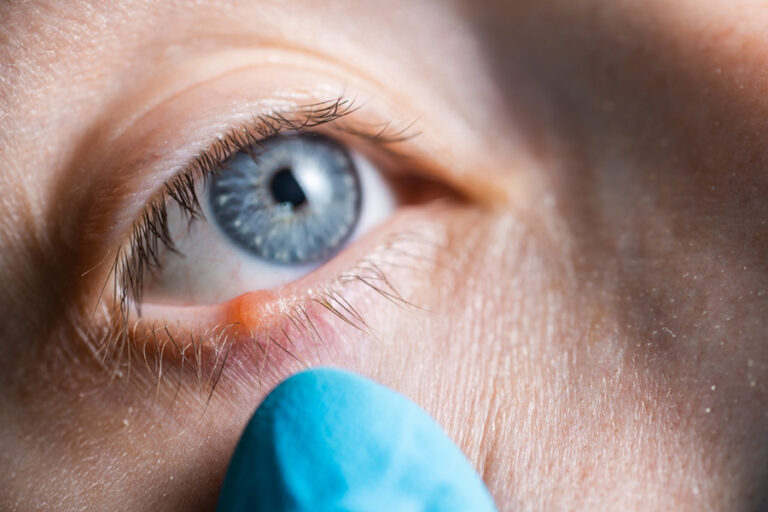 Lesion Excision Danbury | Eyelid Lesion Removal Waterbury, CT